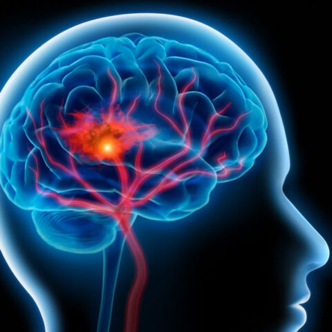 Valoración y cuidados enfermeros a personas con problemas neurológicos ...